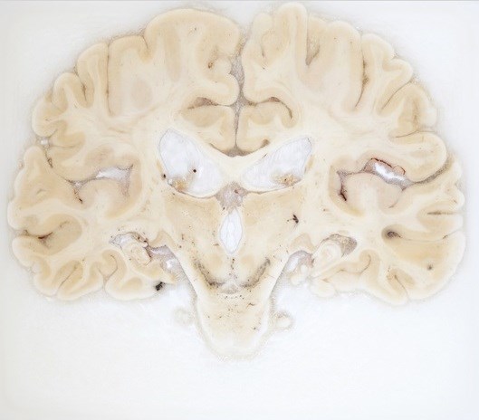 joeLAB.com: H.M.’s Brain